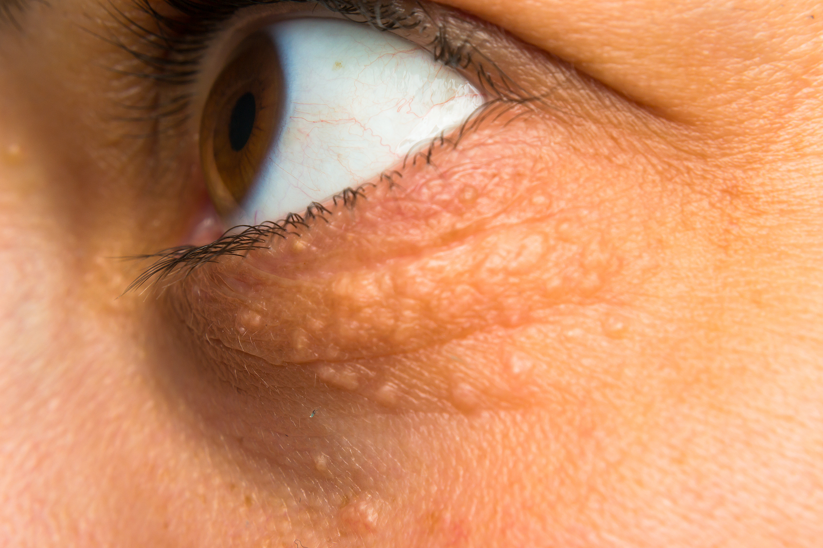 Xanthelasma: What Causes It And When To Consider Treating It